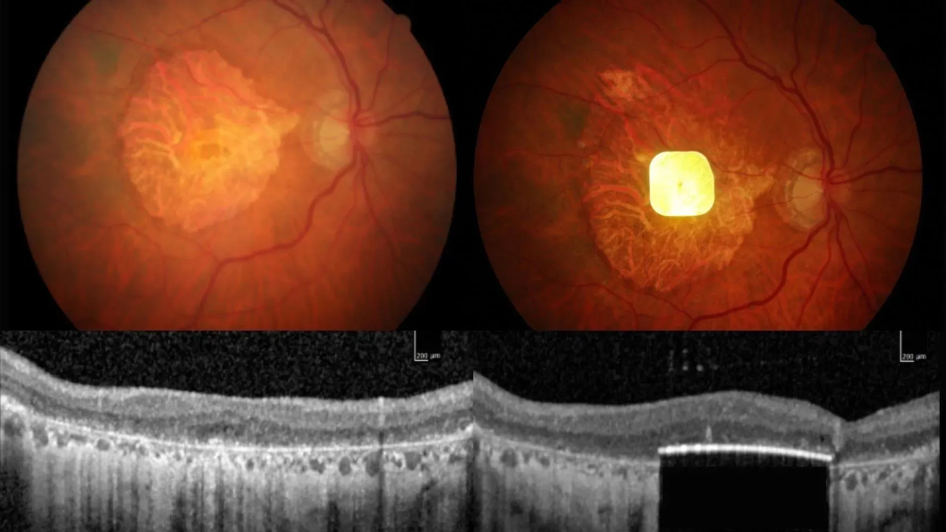 Breakthrough Electronic Eye Implant Restores Reading Vision in Blind ...