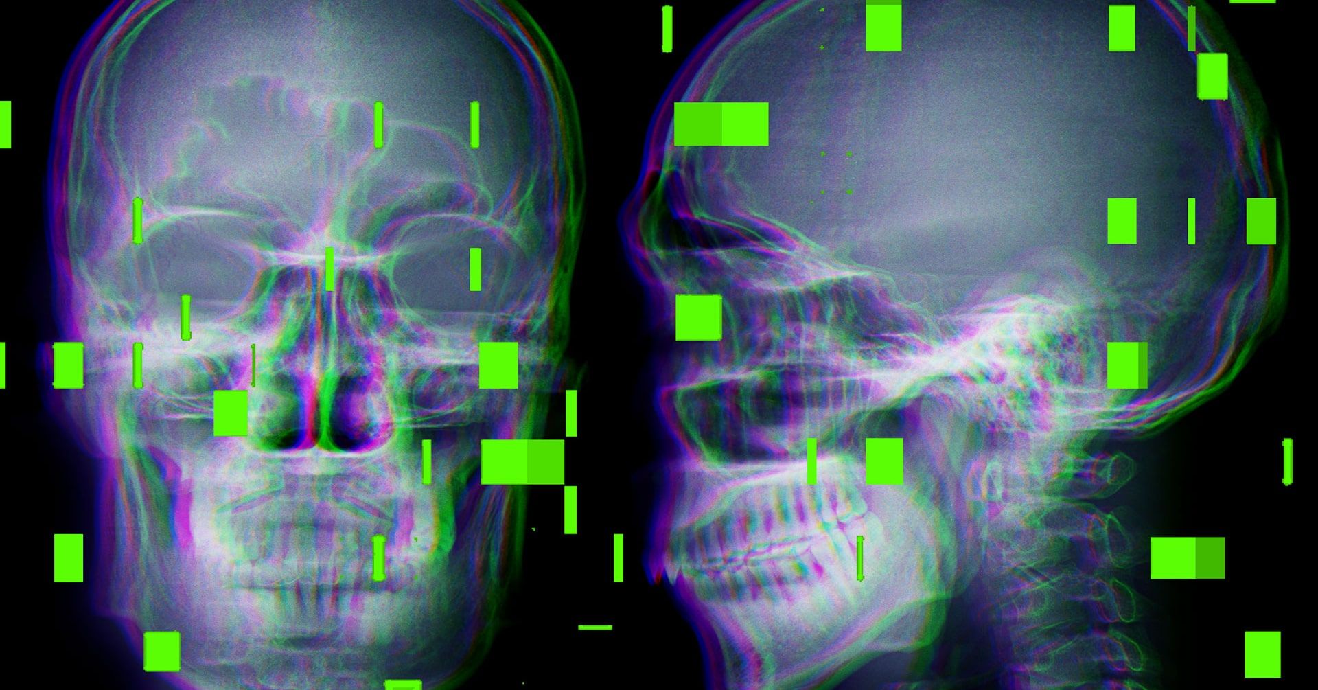AI in Surgery: TruDi System Linked to Patient Injuries