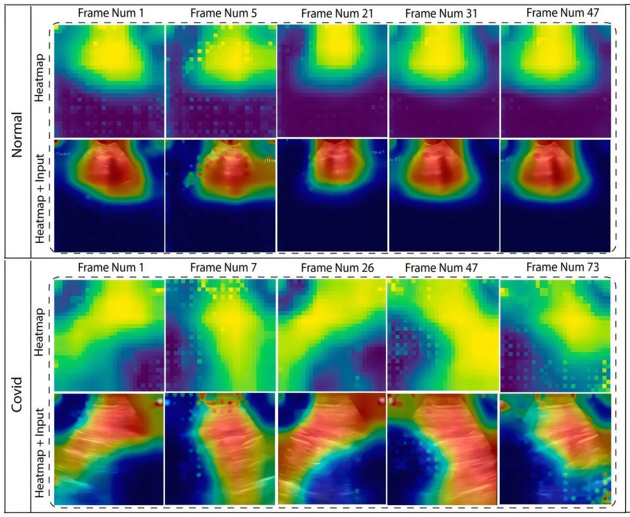 AI Breakthrough: 97% Accuracy in Lung Disease Detection and COVID-19 ...