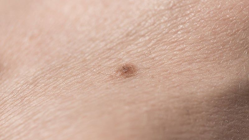 AI Tool for Skin Cancer Triage Receives Conditional NHS Approval