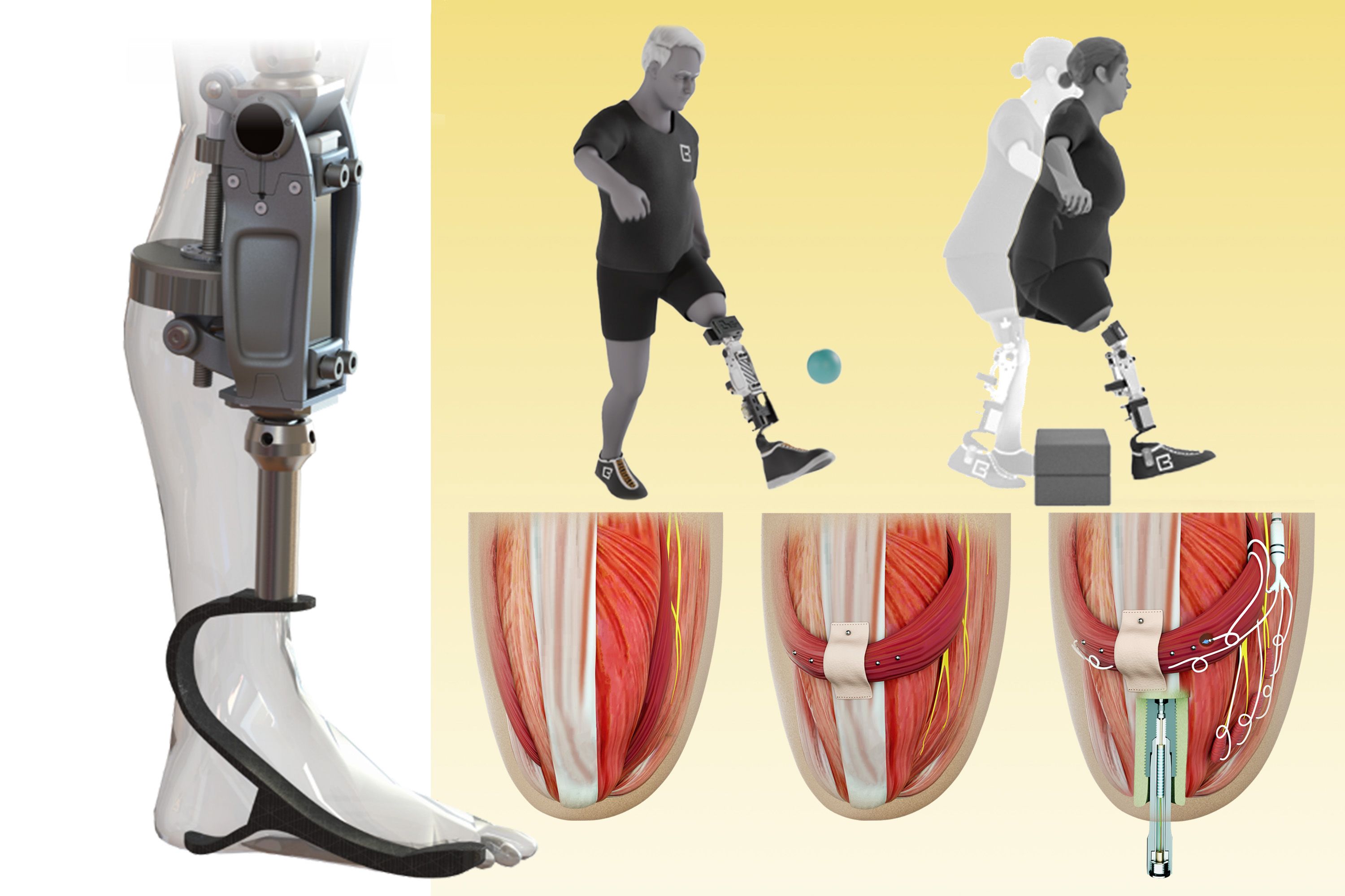 MIT's Bionic Knee Breakthrough: Integrating Prosthetics with Human ...