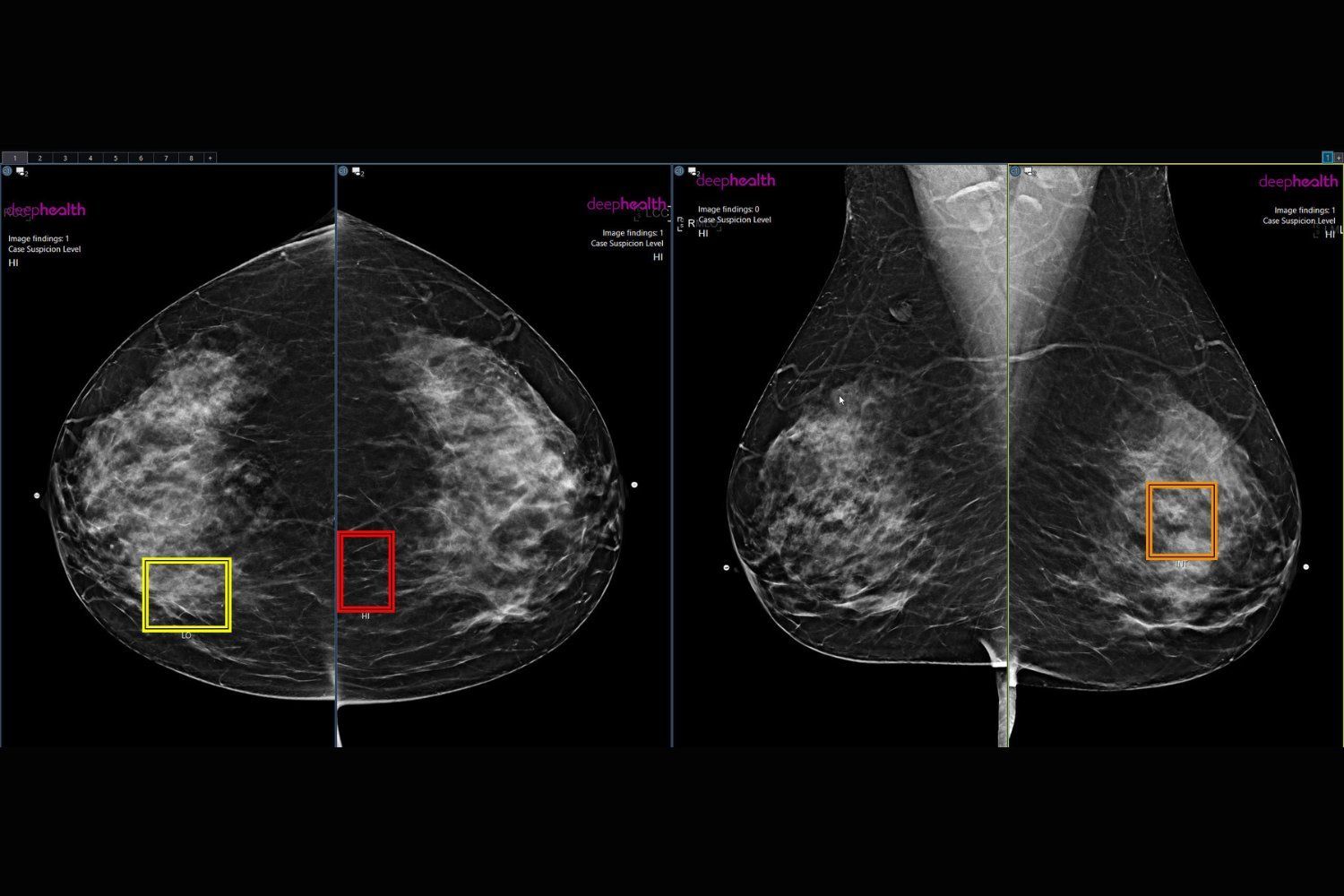 AI-Enhanced Mammography Shows Promise in Boosting Breast Cancer ...